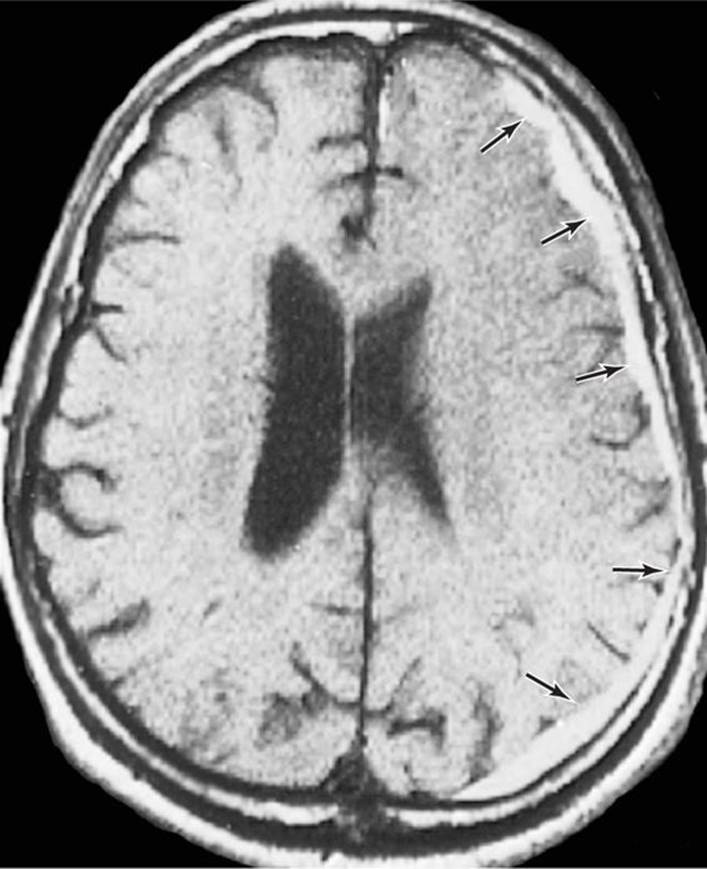 Vascular Supply of the Brain - Clinical Neuroanatomy, 28 ed.
