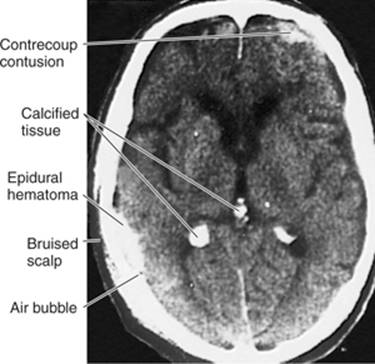 Vascular Supply of the Brain - Clinical Neuroanatomy, 27 ed.
