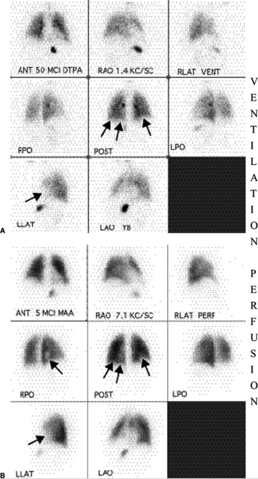 Pulmonary Vascular Disease - The Core Curriculum: Cardiopulmonary ...