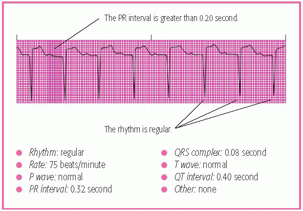 Arrhythmias - RN Expert Guides: Cardiovascular Care, 1st Edition (2008)