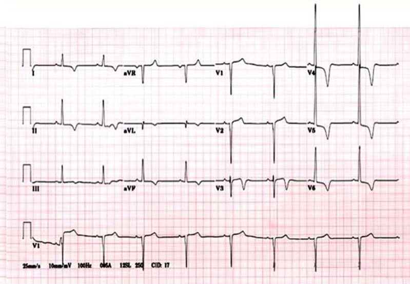 Hypertrophic Cardiomyopathy - The Cleveland Clinic Cardiology Board ...