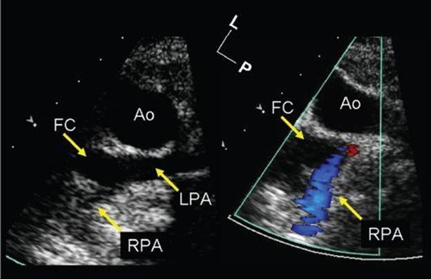 Echocardiographic Evaluation of the Functionally Univentricular Heart ...