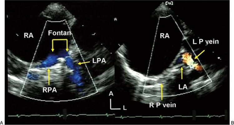 Echocardiographic Evaluation of the Functionally Univentricular Heart ...