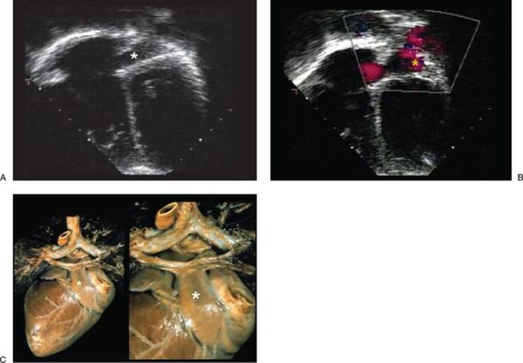 Anomalies of the Pulmonary and Systemic Venous Connections - Echocardiography in Pediatric and ...