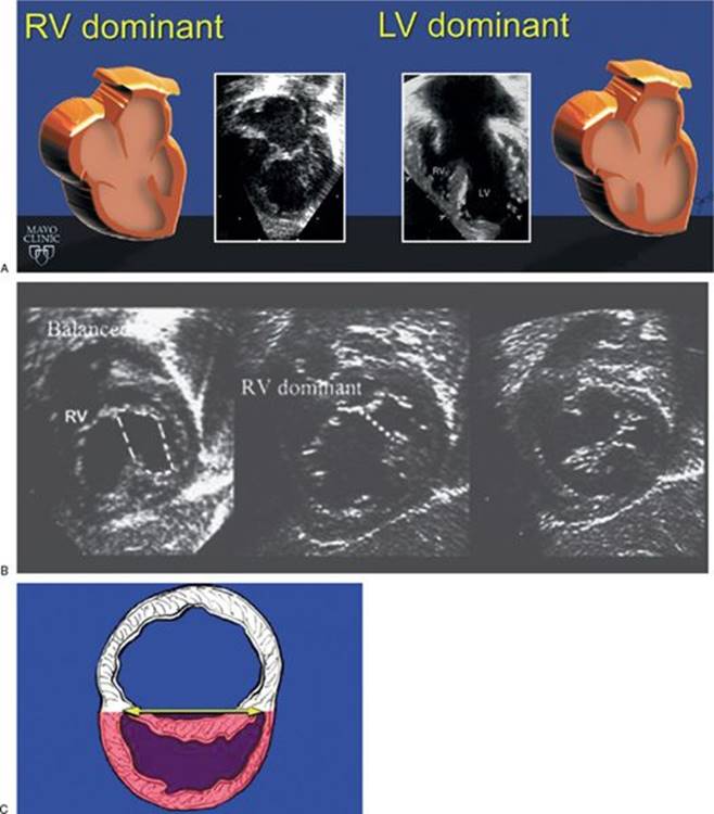 Atrioventricular Septal Defects - Echocardiography in Pediatric and ...