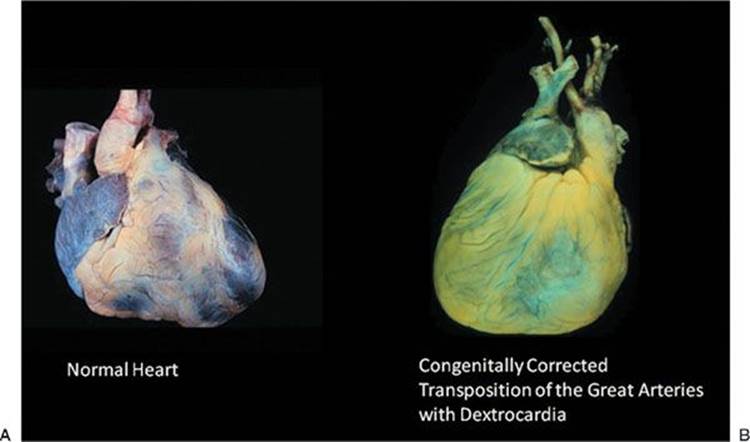 Congenitally Corrected Transposition of the Great Arteries ...