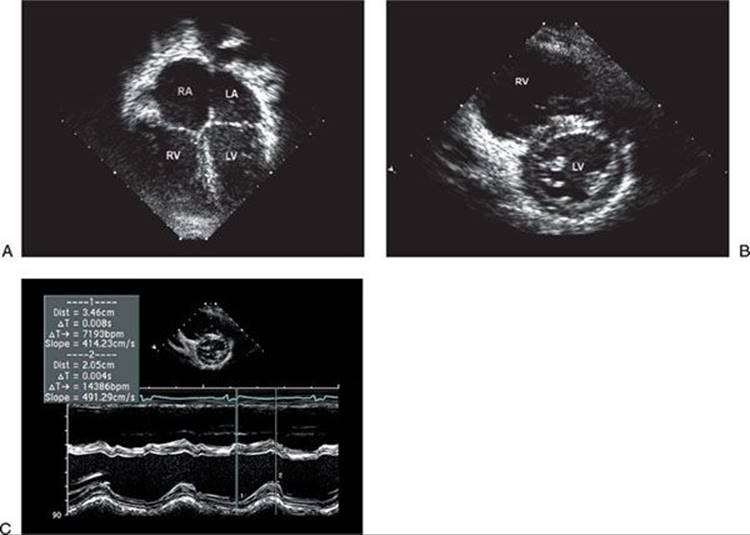 Tetralogy of Fallot - Echocardiography in Pediatric and Adult ...