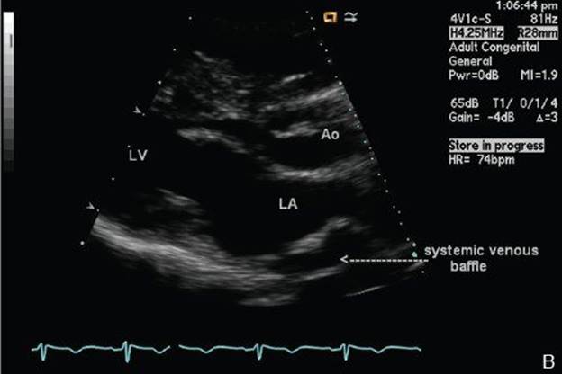 d-Transposition of the Great Arteries - Echocardiography in Pediatric ...