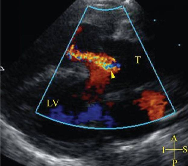 Truncus Arteriosus - Echocardiography in Pediatric and Adult Congenital ...