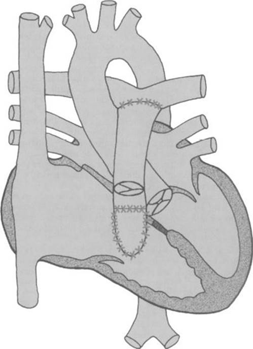 Truncus Arteriosus - Echocardiography in Pediatric and Adult Congenital ...