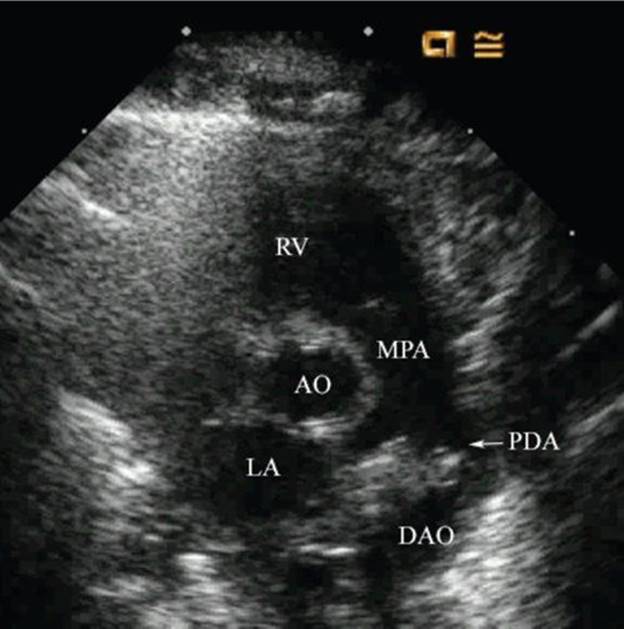 Patent Ductus Arteriosus and Aortopulmonary Window - Echocardiography ...