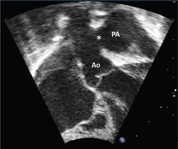Patent Ductus Arteriosus and Aortopulmonary Window - Echocardiography ...