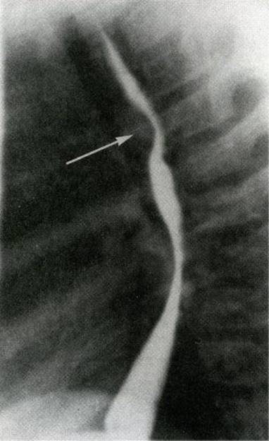 Abnormalities of the Aortic Arch - Echocardiography in Pediatric and ...