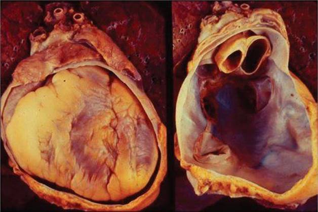 Pericardial Disorders - Echocardiography in Pediatric and Adult Congenital Heart Disease, 2nd Ed.