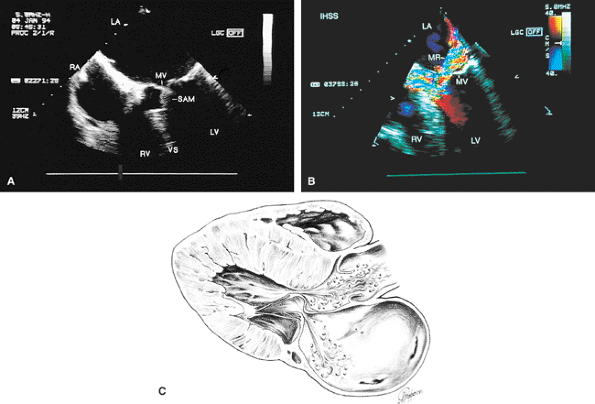 Left Ventricular Function Cardiomyopathy - Atlas of Transesophageal ...