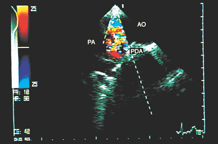 Transesophageal Echocardiography in Congenital Heart Disease - Atlas of ...