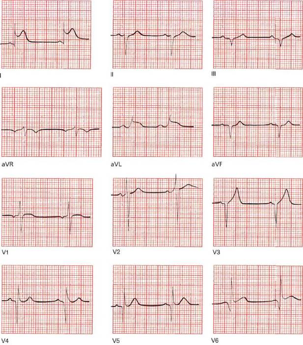 Myocardial Ischemia and Infarction - The only EKG book. 9th Ed