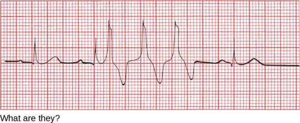 Myocardial Ischemia and Infarction - The only EKG book. 9th Ed