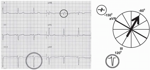 The Electrical Axis and Cardiac Rotation - Basic and Bedside ...