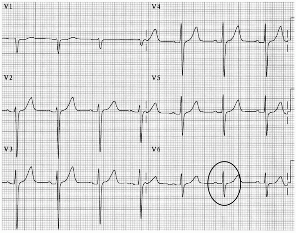 The Electrical Axis and Cardiac Rotation - Basic and Bedside ...