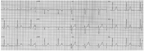 The Electrical Axis and Cardiac Rotation - Basic and Bedside ...