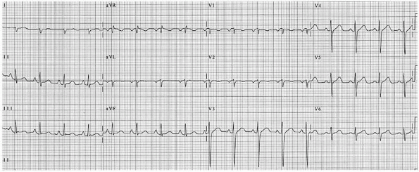 The Electrical Axis and Cardiac Rotation - Basic and Bedside ...