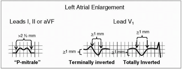 Chamber Enlargement and Hypertrophy - Basic and Bedside ...