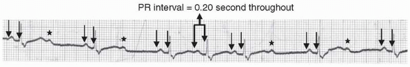 Atrioventricular Block - Basic and Bedside Electrocardiography, 1st ...