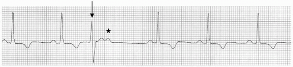 Atrioventricular Block - Basic and Bedside Electrocardiography, 1st ...