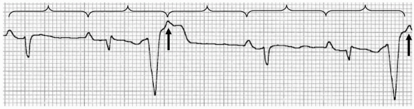 Atrioventricular Block - Basic and Bedside Electrocardiography, 1st ...
