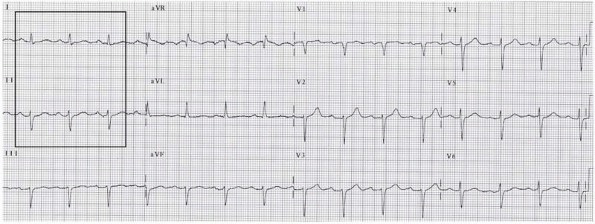 Intraventricular Conduction Defect: Fascicular Block - Basic and ...