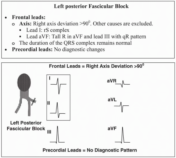 Intraventricular Conduction Defect: Fascicular Block - Basic and ...
