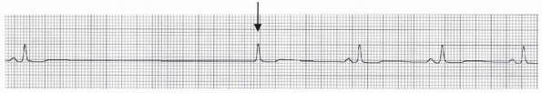 Sinus Node Dysfunction - Basic and Bedside Electrocardiography, 1st ...
