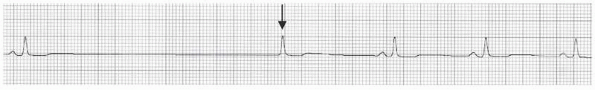 Sinus Node Dysfunction - Basic and Bedside Electrocardiography, 1st ...