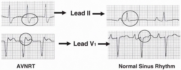 Supraventricular Tachycardia due to Reentry - Basic and Bedside ...