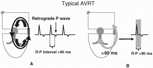 Supraventricular Tachycardia due to Reentry - Basic and Bedside ...