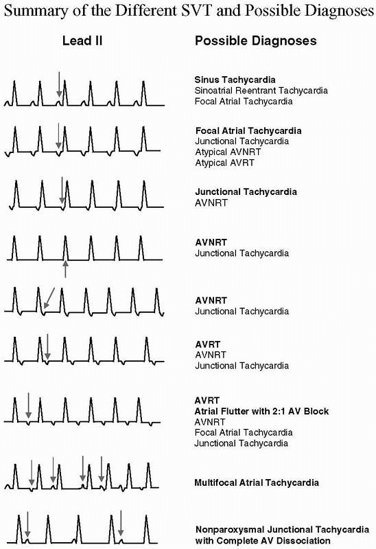 Supraventricular Tachycardia due to Altered Automaticity - Basic and ...