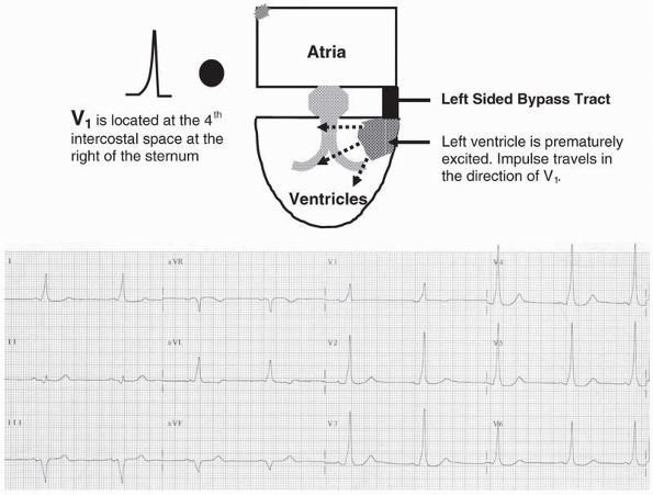 Wolff-Parkinson-White Syndrome - Basic and Bedside Electrocardiography ...