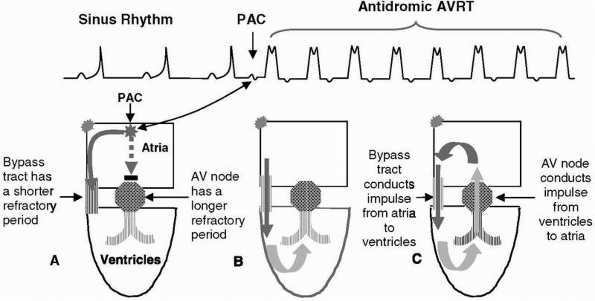 Wolff-Parkinson-White Syndrome - Basic and Bedside Electrocardiography ...