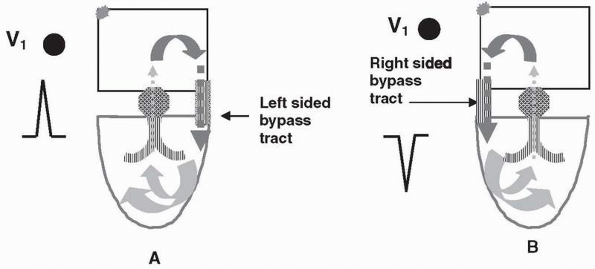 Wolff-Parkinson-White Syndrome - Basic and Bedside Electrocardiography ...