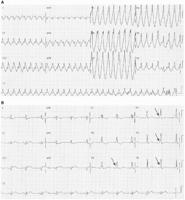 Wolff-Parkinson-White Syndrome - Basic and Bedside Electrocardiography ...