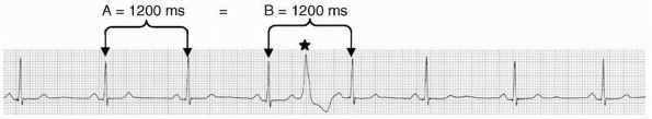Ventricular Arrhythmias - Basic and Bedside Electrocardiography, 1st ...