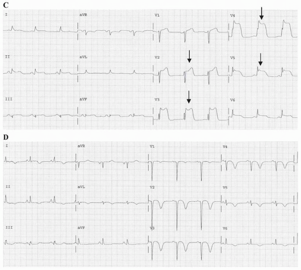 Acute Coronary Syndrome: ST Elevation Myocardial Infarction - Basic and ...