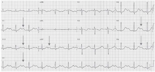 Electrolyte Abnormalities - Basic and Bedside Electrocardiography, 1st ...