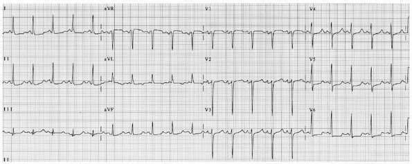 Electrolyte Abnormalities - Basic and Bedside Electrocardiography, 1st ...