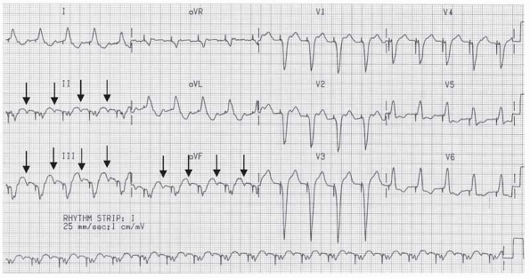 The ECG of Cardiac Pacemakers - Basic and Bedside Electrocardiography ...