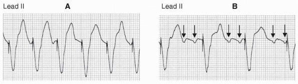 The ECG of Cardiac Pacemakers - Basic and Bedside Electrocardiography ...