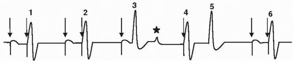 The ECG of Cardiac Pacemakers - Basic and Bedside Electrocardiography ...