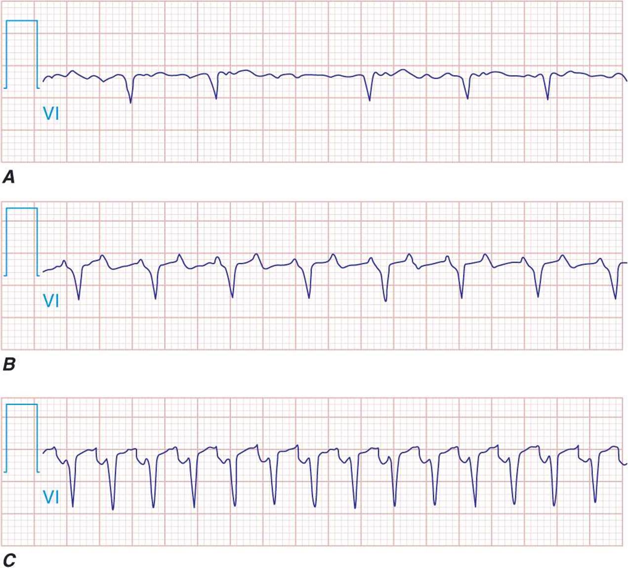 THE TACHYARRHYTHMIAS - HEART RHYTHM DISTURBANCES - Harrison's ...
