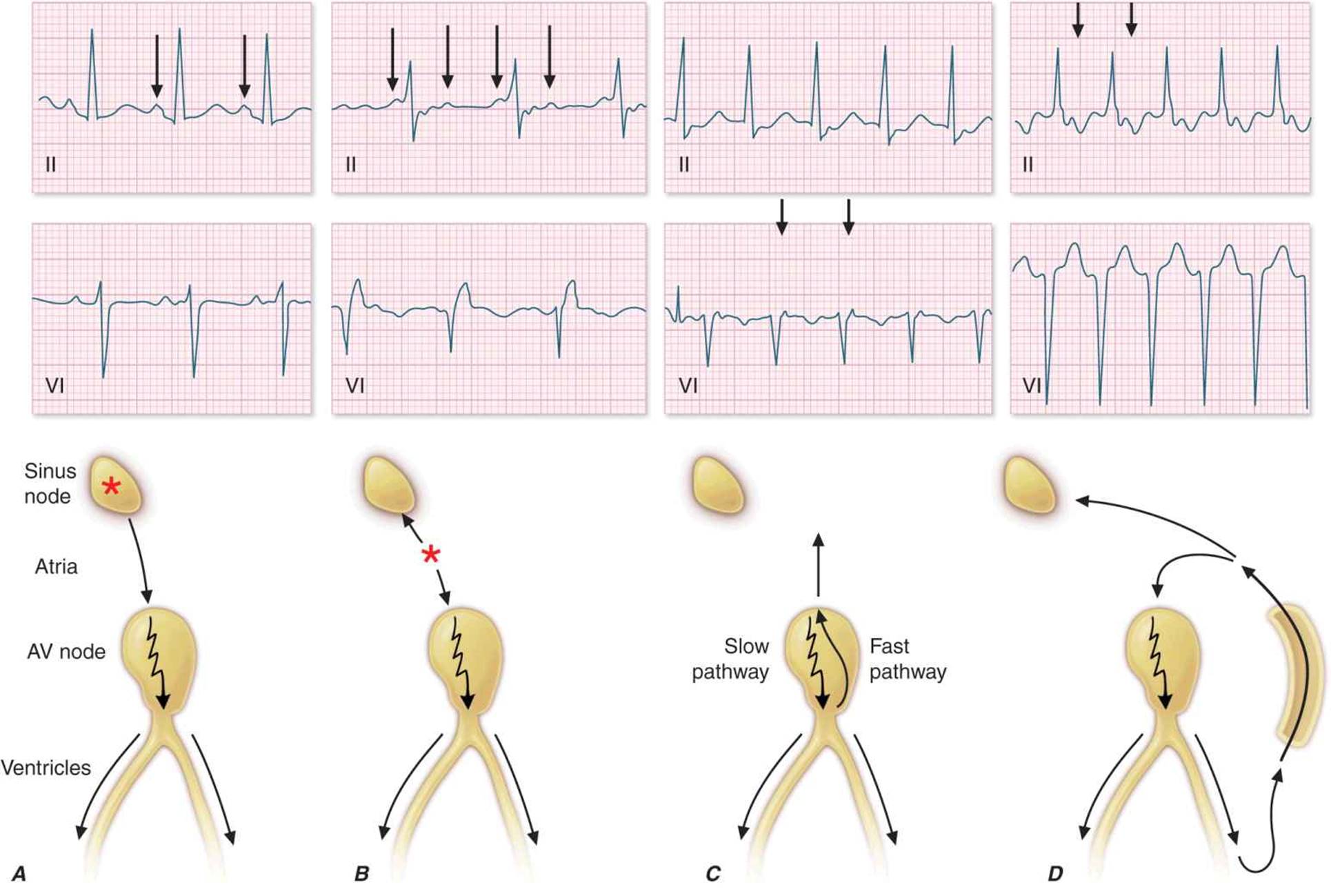THE TACHYARRHYTHMIAS - HEART RHYTHM DISTURBANCES - Harrison's ...